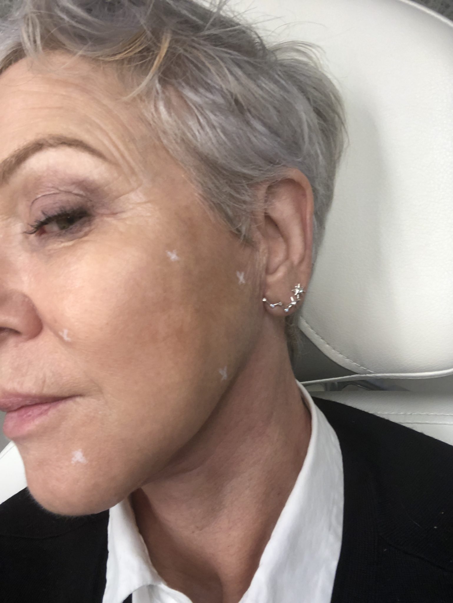 Profhilo och jag har träffats – igen! - Daisy Beauty Profhilo och jag har träffats – igen! - Daisy Beauty